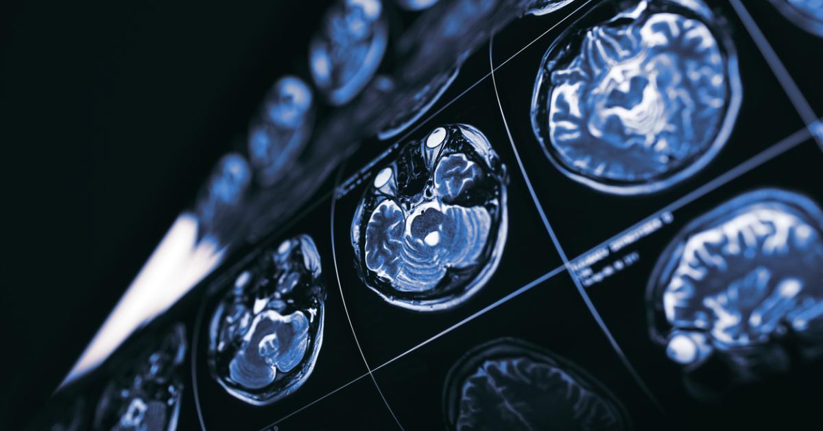 Personalized Model Unveils Hidden Patterns in Alzheimer’s Progression ...